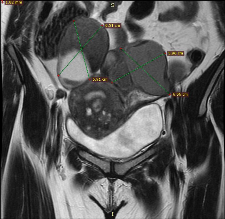 Spotlight On: Fibroids - AAGL